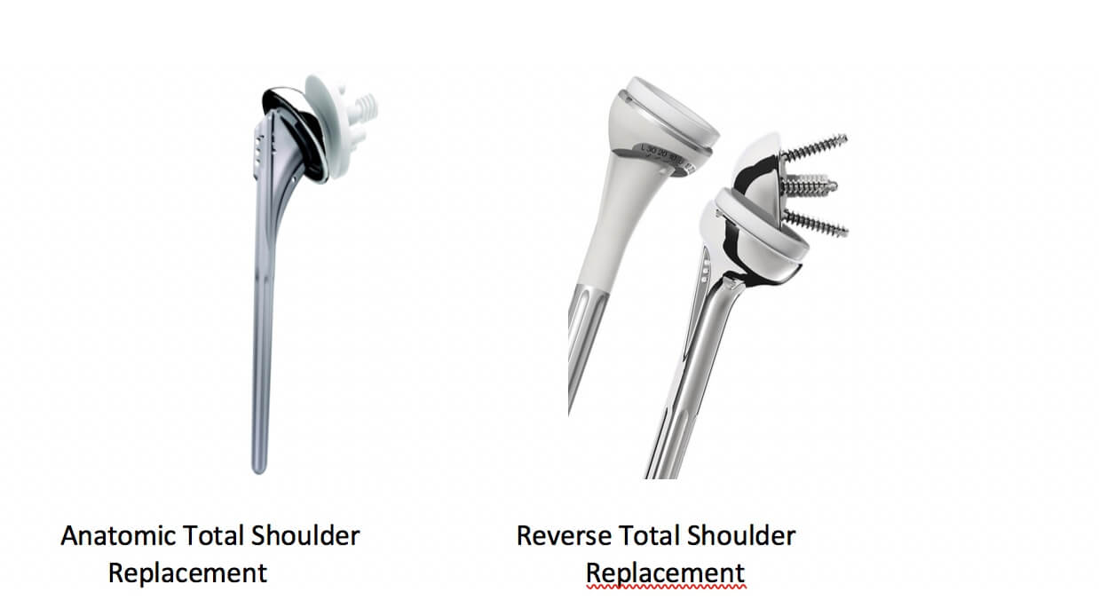 Shoulder Surgery: Reconstruction vs Replacement | Glenelg Orthopaedics