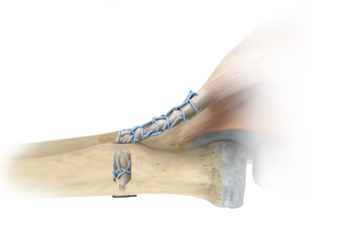 Discover the Causes and Symptoms of Distal Biceps Tendon Injury ...